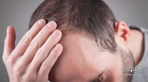 What Is The Best Treatment For Capillary Fragility