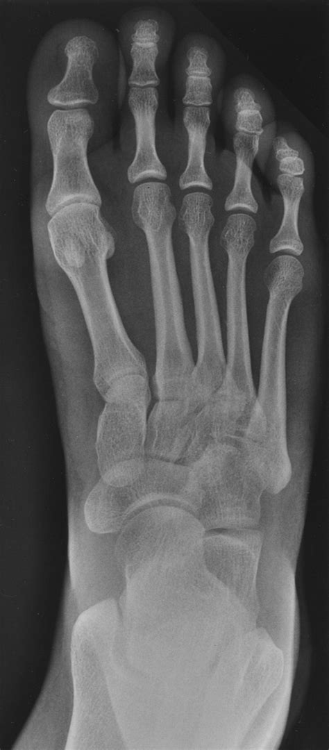 Avulsion Fracture X Ray