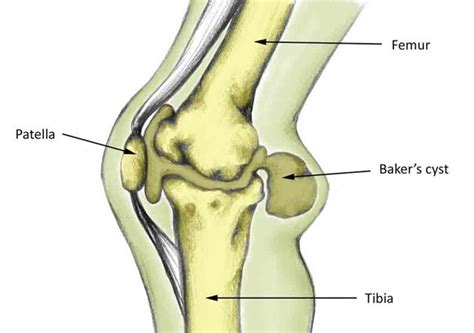 Bakers Cyst Symptoms Causes Treatment And Rehabilitation