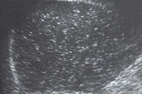 Liver Pathologies Flashcards In 2025 Diagnostic Medical Sonography Pathology Flashcards