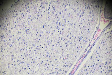 Seminoma 스톡 사진 및 일러스트 Istock