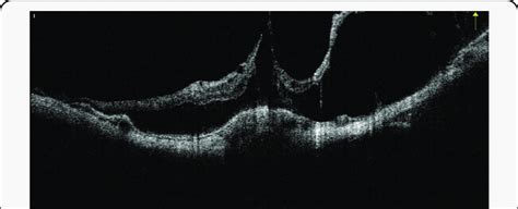 OCT Showing Macular Retinoschisis With Inner Lamellar Hole In The