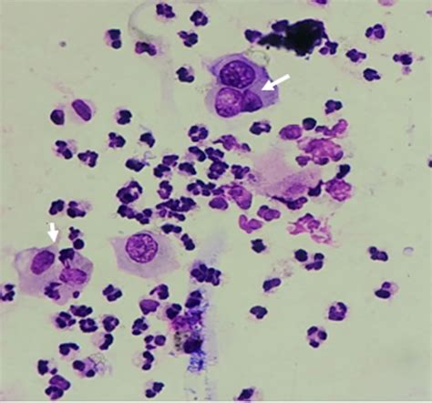 Acantholytic Cells