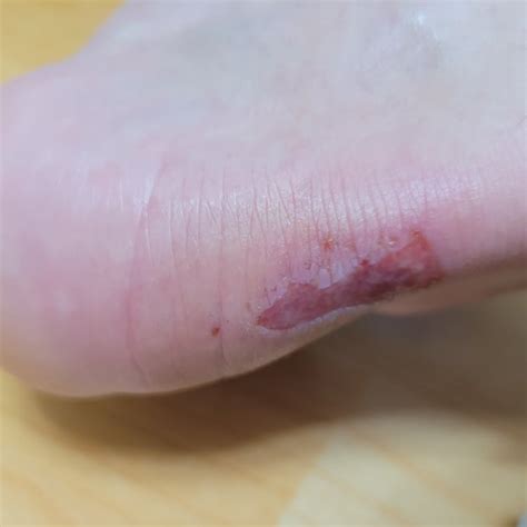 피부과 상처 소독 메디폼 듀오덤 지식in