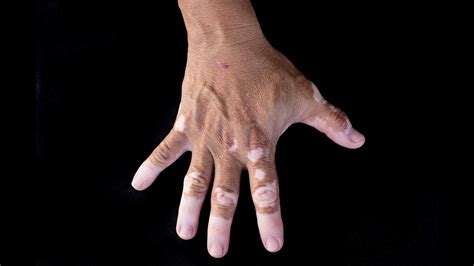 What Are The Symptoms Of Vitiligo Vitiligo Center