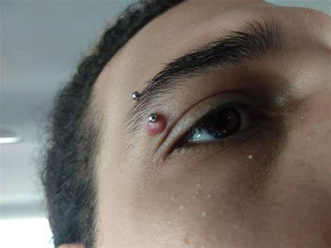 Recurring Eyebrow Bump R Piercingadvice