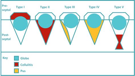 Preseptal Cellulitis Vs Orbital Cellulitis