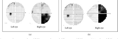 Lymphocytic Infundibuloneurohypophysitis Semantic Scholar