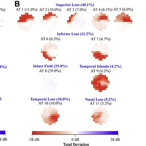 A Seventeen Central Visual Field Vf Patterns Determined By Download Scientific Diagram
