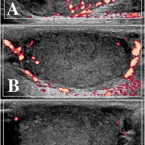 Histopathological Section Of The Central Part Of A Chondrosarcoma Dog