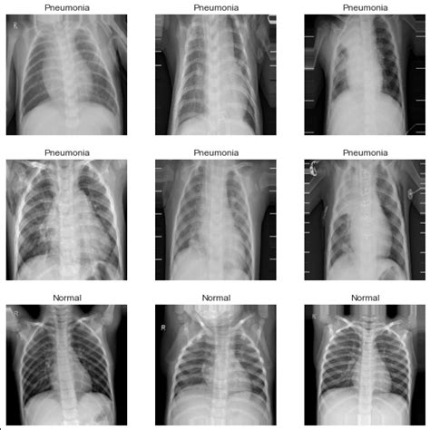 X Ray Pneumonia Classification Final Notebook Ipynb At Main · 281clo X Ray Pneumonia