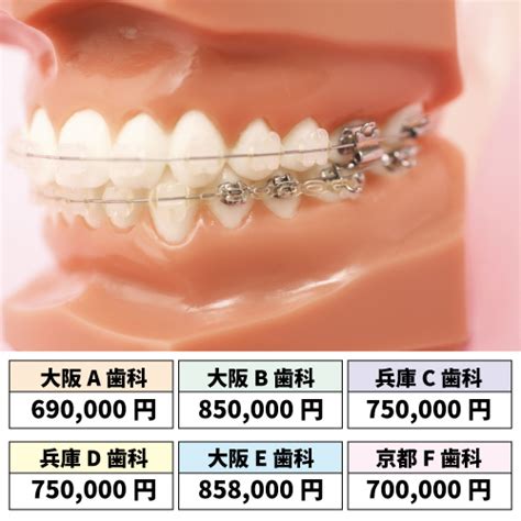 歯の矯正の気になる値段や支払い方法 梅田アップル歯科