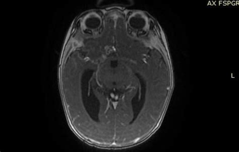 Post Embolization Dsa Immediately After The Embolization Lateral