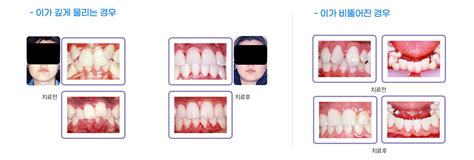 교정치료종류 치열교정