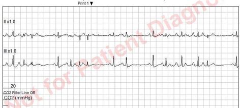 Afib W Wpw To Sinus W Weird Ectopy Rekgs