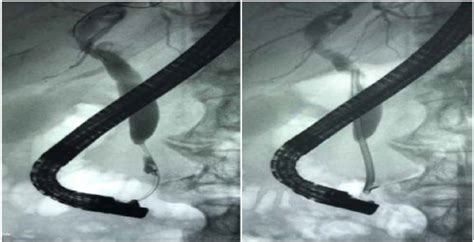 Main Bile Duct Malignant Stenosis Due To Pancreatic Cancer With Plastic