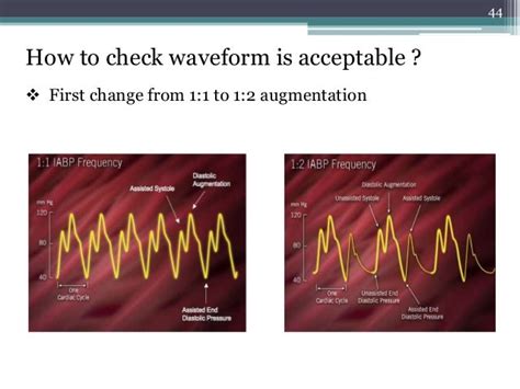 Iabp Instrumentation Indications And Complications