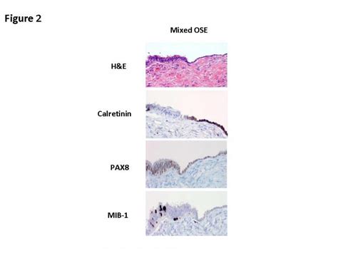 Precursors Of Type Ii Endometrial Cancer Zheng Lab Ut Southwestern