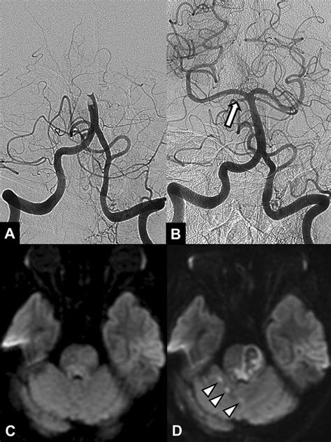 A 64 Year Old Female Patient With Acute Stroke Due To Basilar Artery