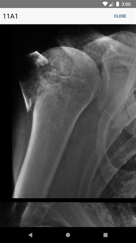 Aoota Fracture Classification Apk For Android Download