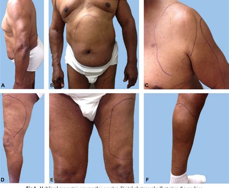 Figure 1 From Multilevel Symmetric Neuropathic Pruritus Msnp