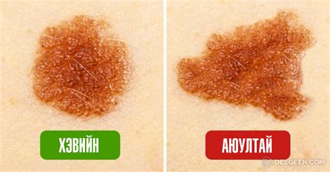 Таны бие дээр бий болсон мэнгэ аюултай өвчнийг илтгэж байж болзошгүй 5 шинж тэмдэг