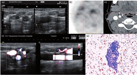 Fn Multimodal Imaging In A 49 Year Old Patient Routine Us Had Detected