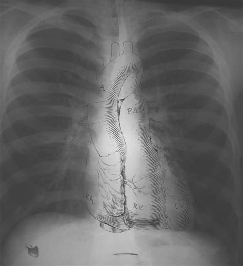 Cxr Interpretation My Gp Notes