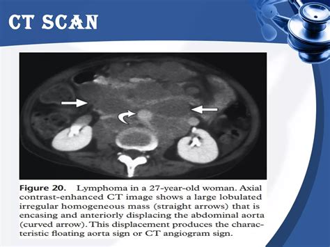 Final Retroperitoneal Tumors Ppt Ppt