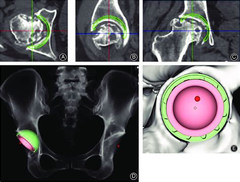 Ct Based Planning For Acetabular Component A Simulation Of