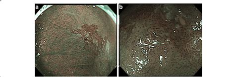 A Nbi Revealed A Demarcated Brownish Dotted Area Before Magnification