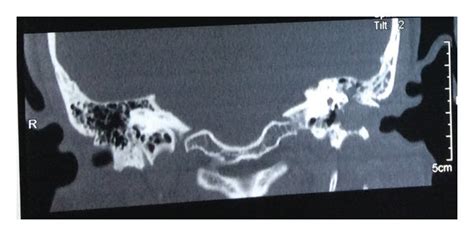 A High Resolution Computed Tomography Hrct Temporal Bone Axial View