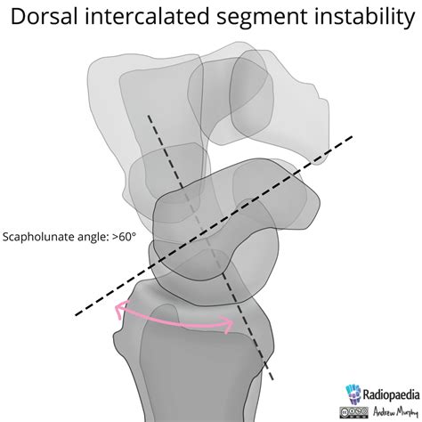 Filenormal Wrist Alignment Dorsal And Volar Intercalated Segmental Instability Illustration Filenormal Wrist Alignment Dorsal And Volar Intercalated Segmental Instability Illustration