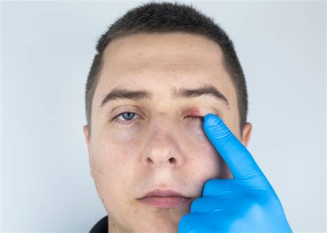 What Is Eyelid Drooping Yun Wong Eye Surgeon
