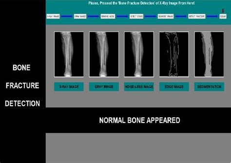 Figure 8 From Image Processing For Detecting Bone Fractures Semantic