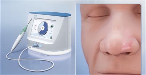 New Vivaer Aerin Medical Vivaer