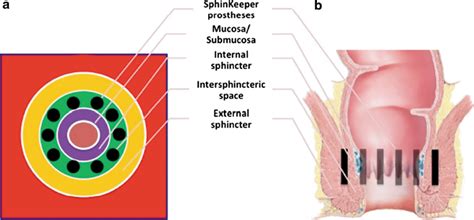 The Site Of Sphinkeeper™ Implantation Within The Interspincteric Space