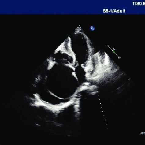 Transthoracic Echocardiography Showing Dilated Right Atrium Right