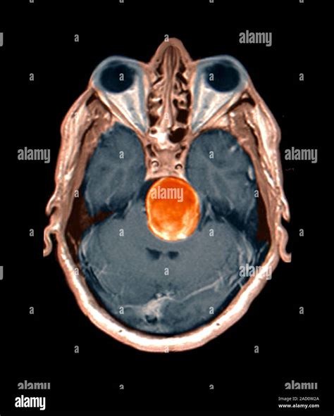 Gehirn Aneurysm Farbige Magnetresonanztomographie Mrt Scan Eines