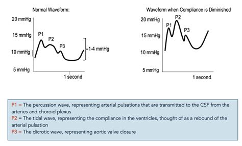 Emcrit Evd Waveform Rebel Em Emergency Medicine Blog