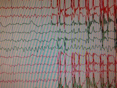Artifacts And Normal Variants In Eeg