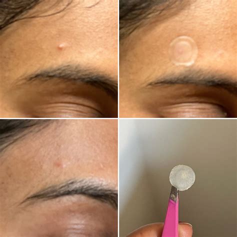 Good Molecules Pimple Patch Review With Photos Ps Beauty Good Molecules Pimple Patch Review With Photos Ps Beauty