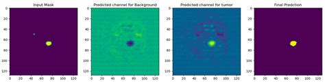 Segmentation Of Liver Tumors By Monai And Pytorch In Ct Images With