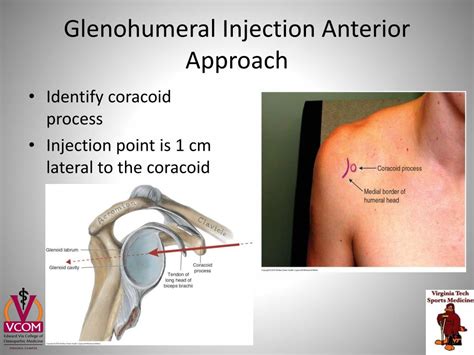 Ppt Shoulder Girdle Joint Injection Workshop Powerpoint Presentation