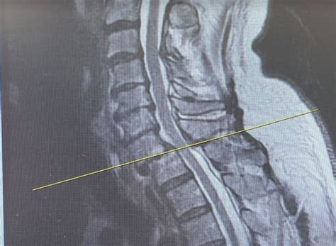 Neuro Alert On Linkedin Proud Recognize Subluxation Decline Surgeon Weakness Extremities…