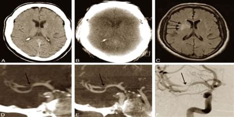 Brain Ischemia Assignment Point