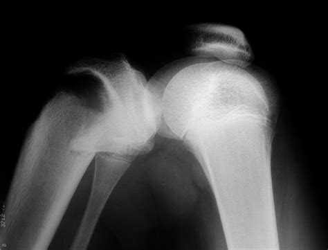 Definite Swelling Of The Upper Outline Of The Tibia Figure The Download Scientific Diagram