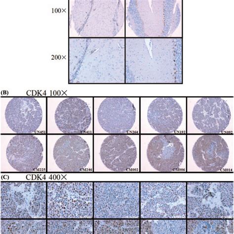 Expression Of Cdk4 Protein Within The Local Microenvironment Of Pob Cm