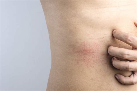 Ruam Kulit Akibat Hiv Penyebab Gejala Dan Cara Mengatasinya
