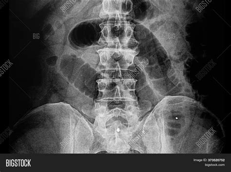 Labeled Abdominal X Ray